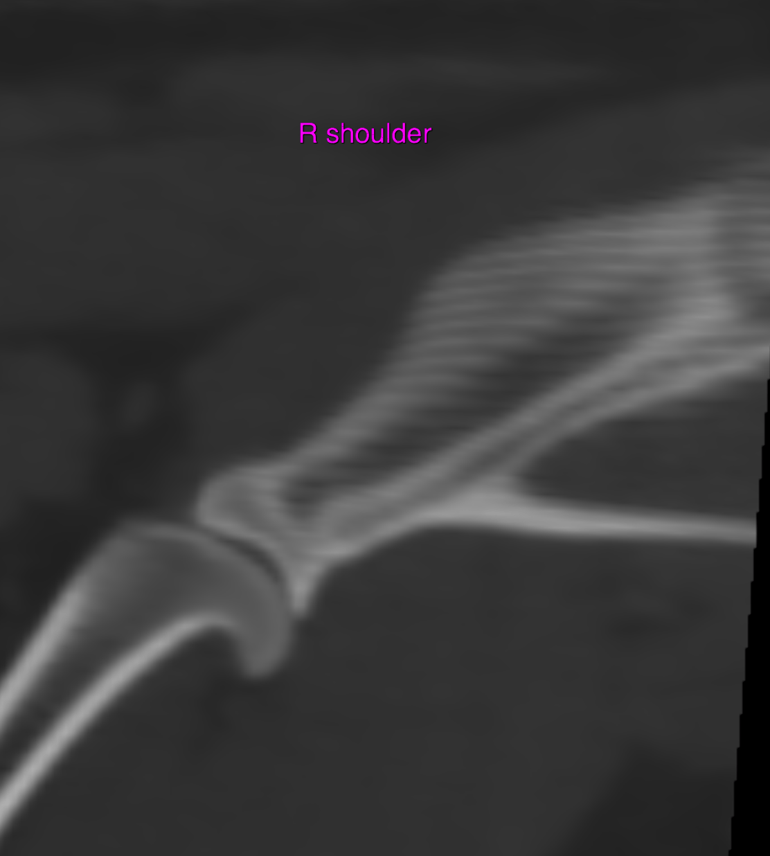 CT - Intervertebral disc disease (IVDD) with compressive myelopathy in ...