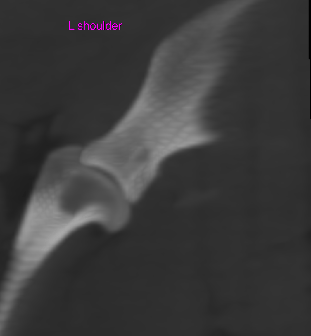 CT - Intervertebral disc disease (IVDD) with compressive myelopathy in ...