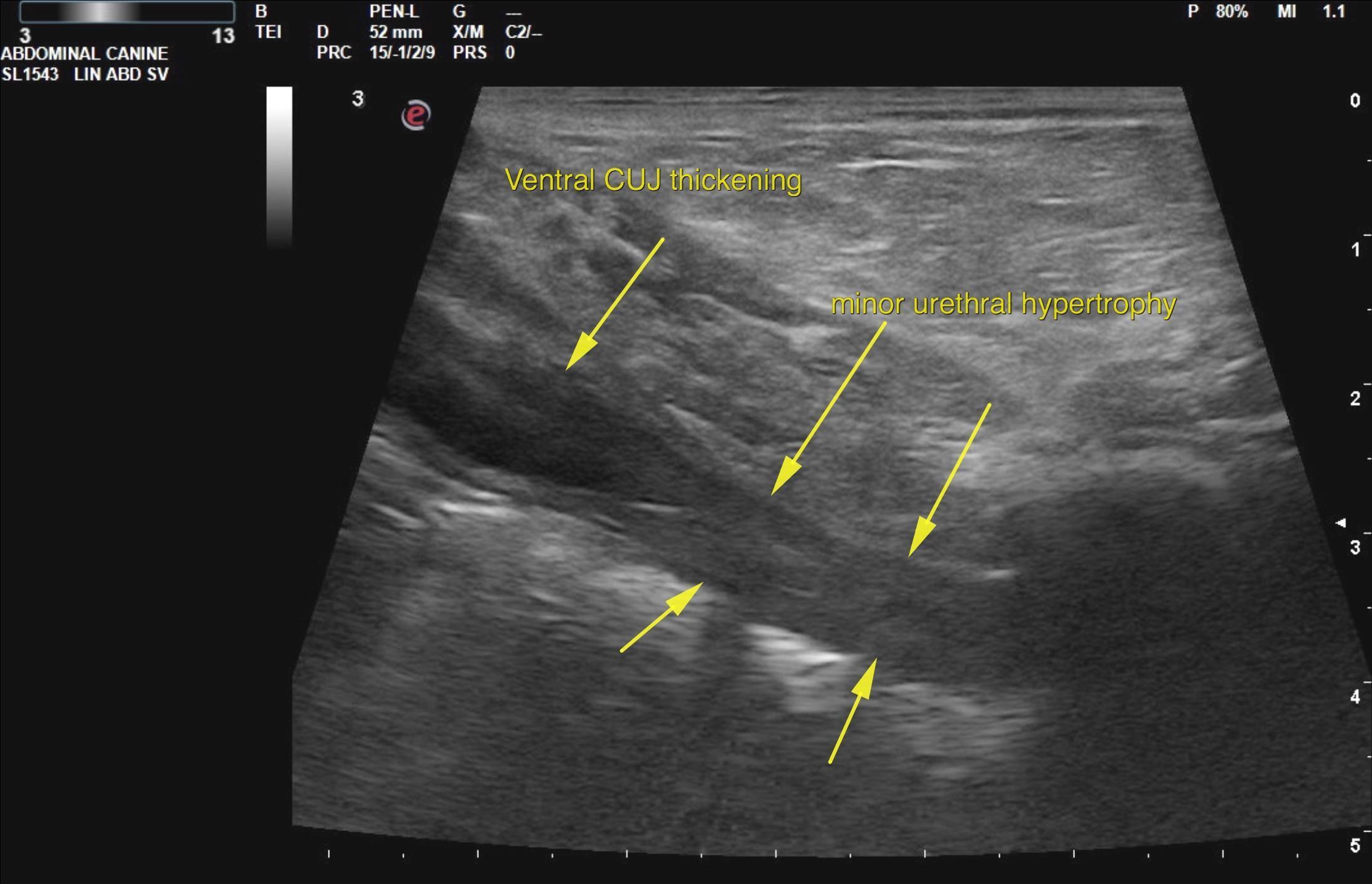 Thickened ventral bladder wall and apex, R/O chronic cystitis, TCC , or ...