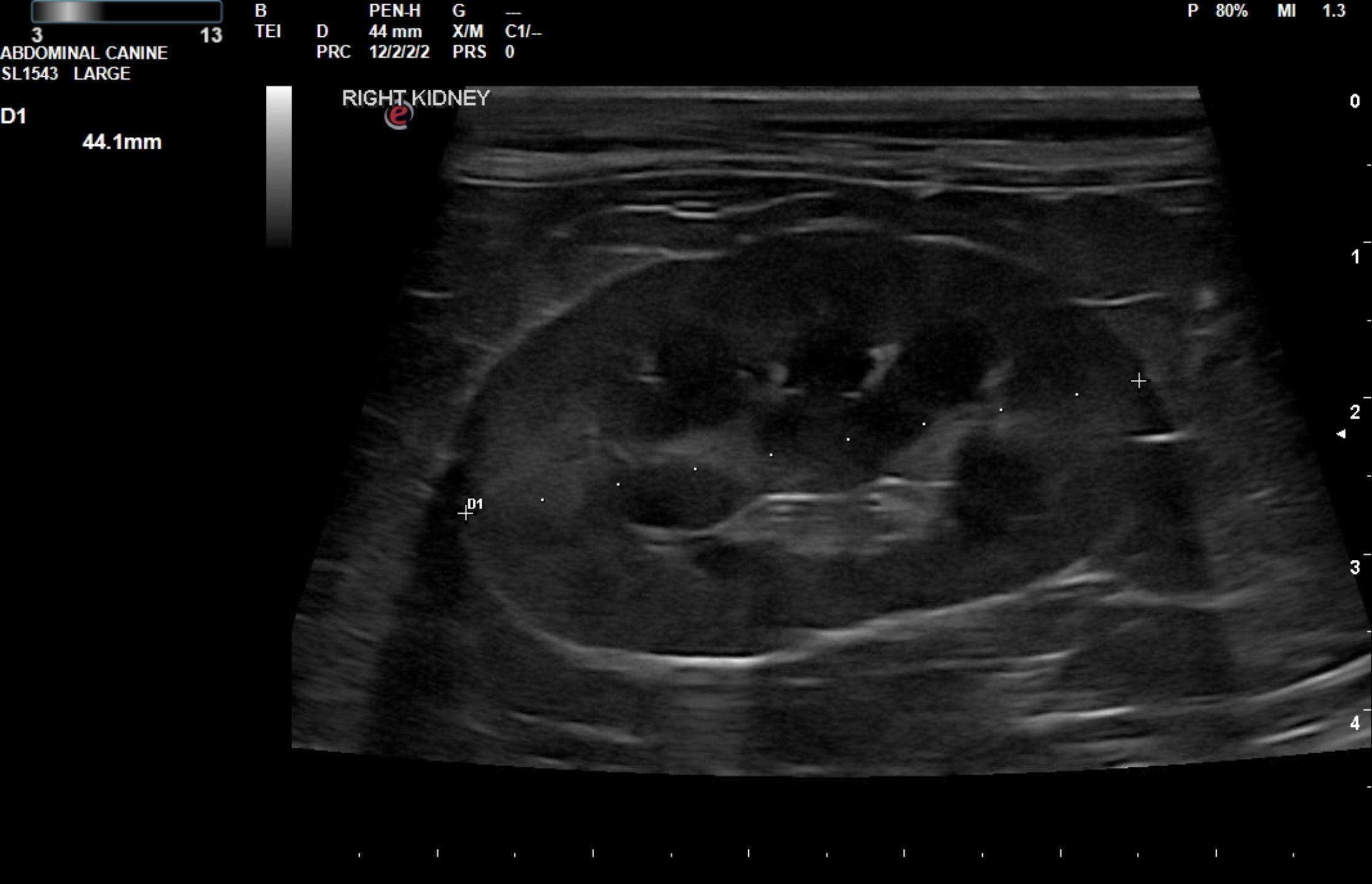 Ureteral calculus at the level of the ureteral papillae and minor ...
