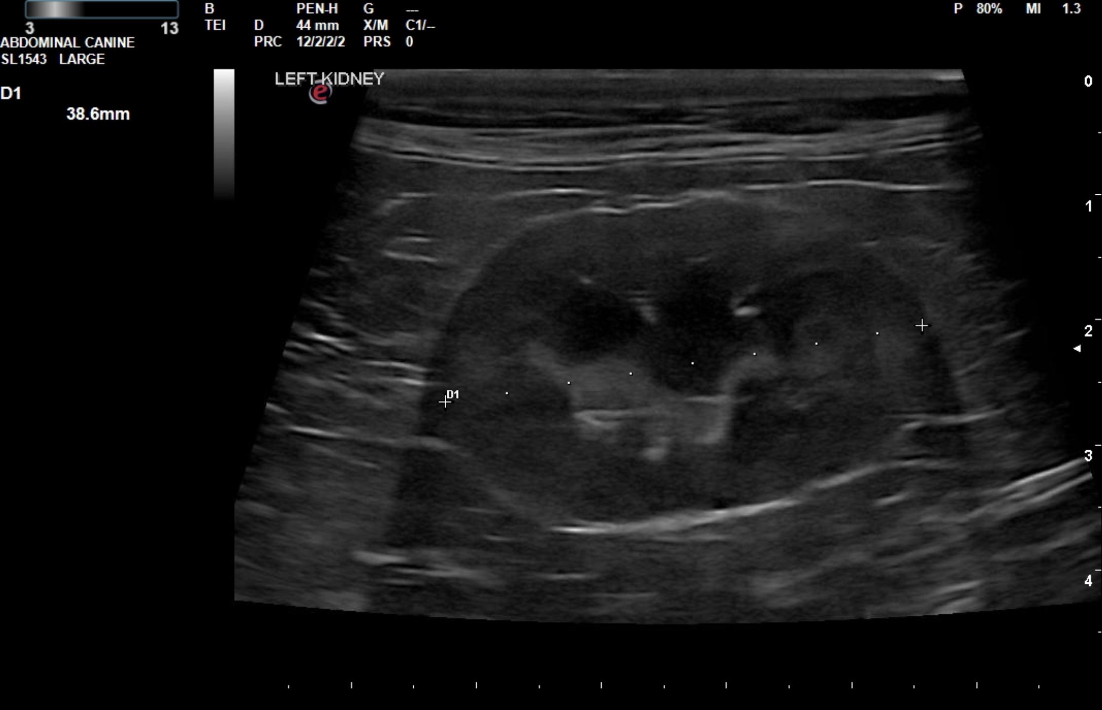 Ureteral calculus at the level of the ureteral papillae and minor ...