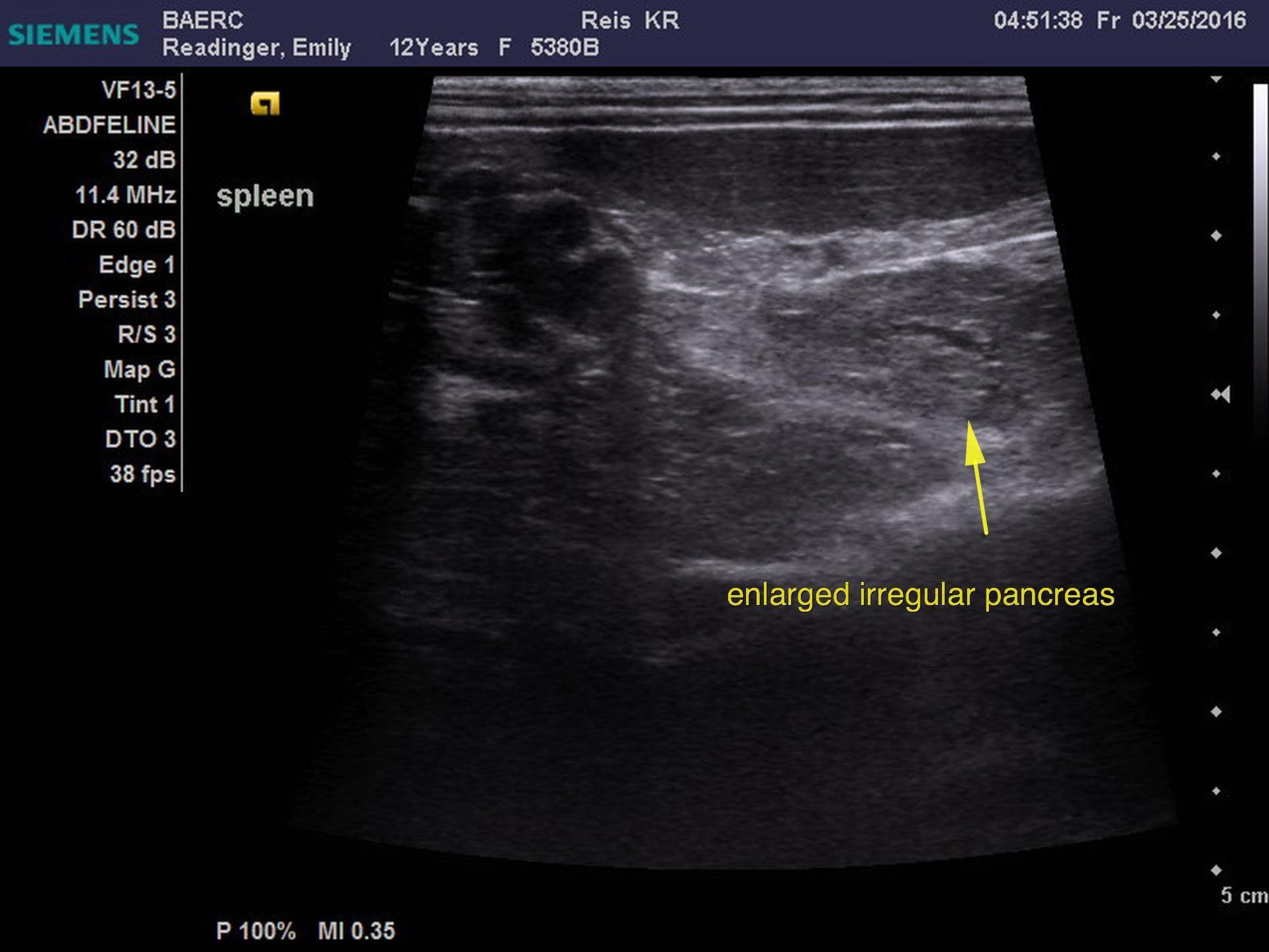 Acute on chronic pancreatitis with bilateral pyelectasia and IBD in a ...