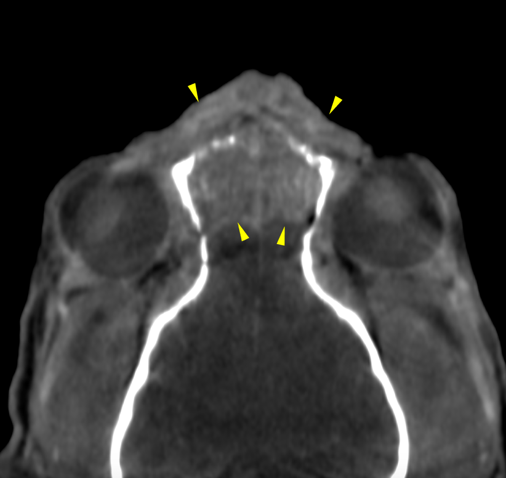 CT - Malignant sinus neoplasia with extensive bone destruction in a 8 ...