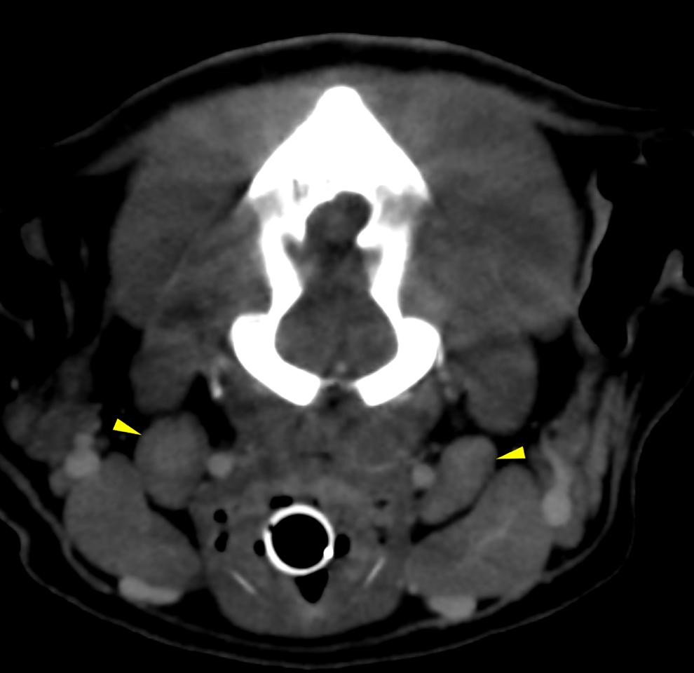 CT - Malignant sinus neoplasia with extensive bone destruction in a 8 ...