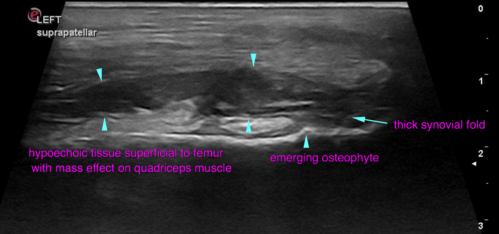ORTHO - Chronic partial avulsion rupture of the patellar ligament, pre ...