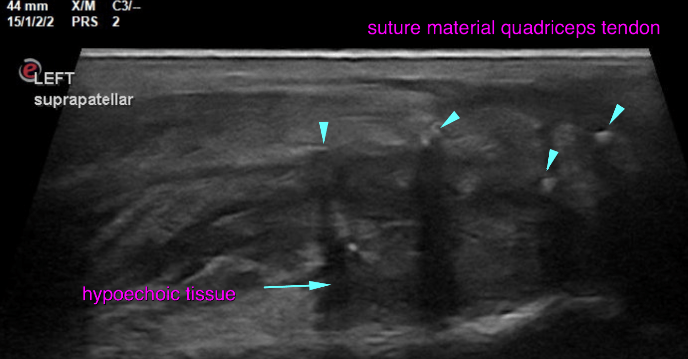ORTHO - Chronic partial avulsion rupture of the patellar ligament, pre ...