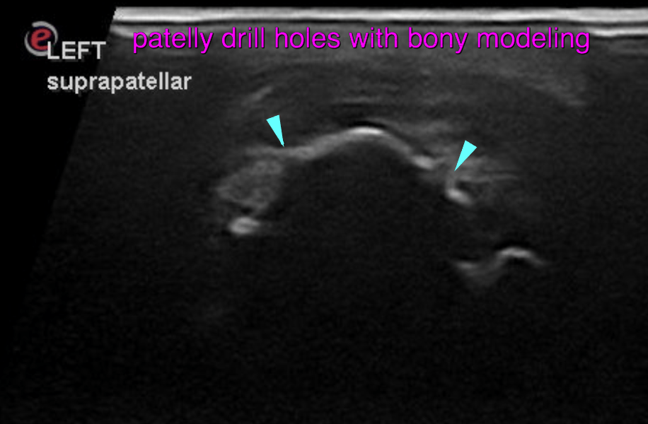 ORTHO - Chronic partial avulsion rupture of the patellar ligament, pre ...