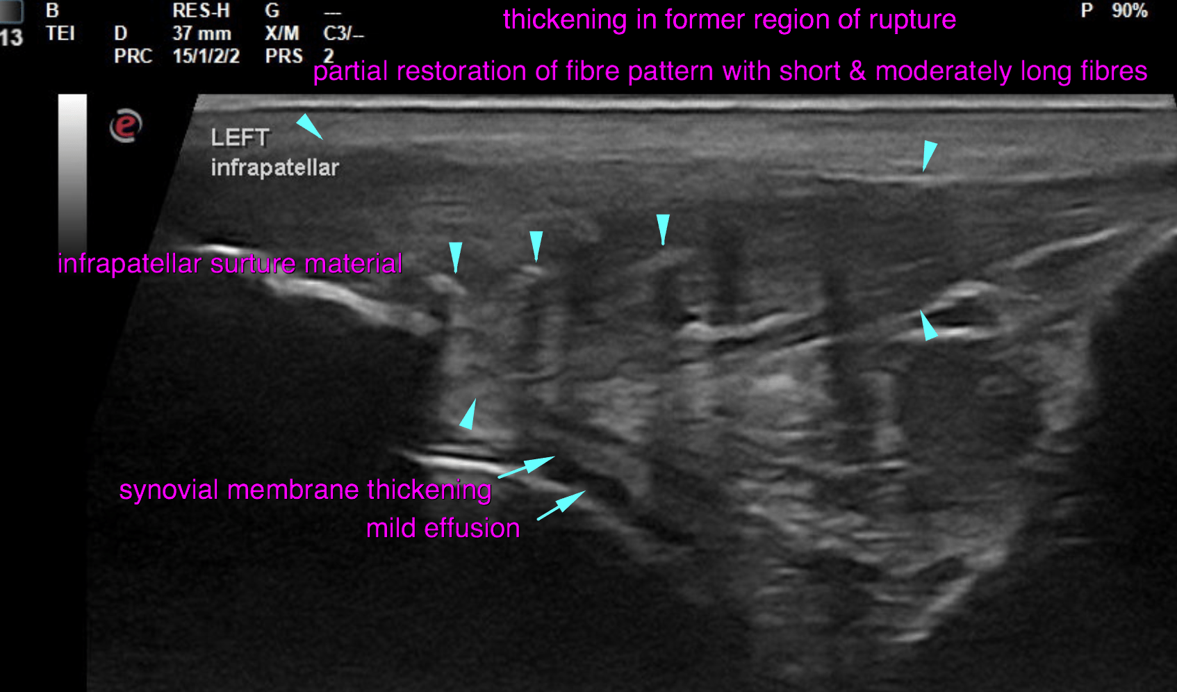 ORTHO - Chronic partial avulsion rupture of the patellar ligament, pre ...
