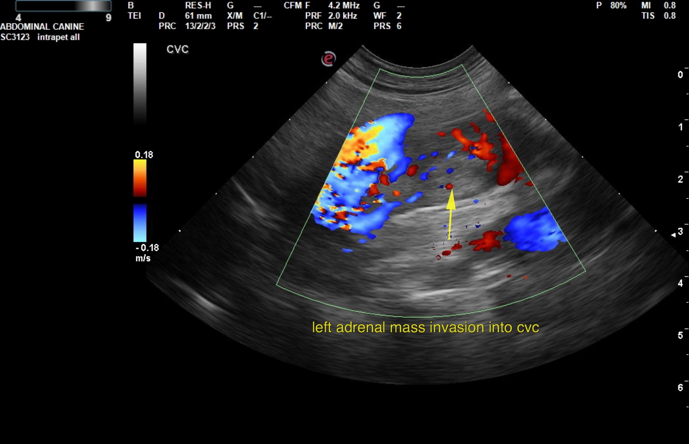 Left adrenal mass with phrenic vein and vena caval invasion in a 13 ...