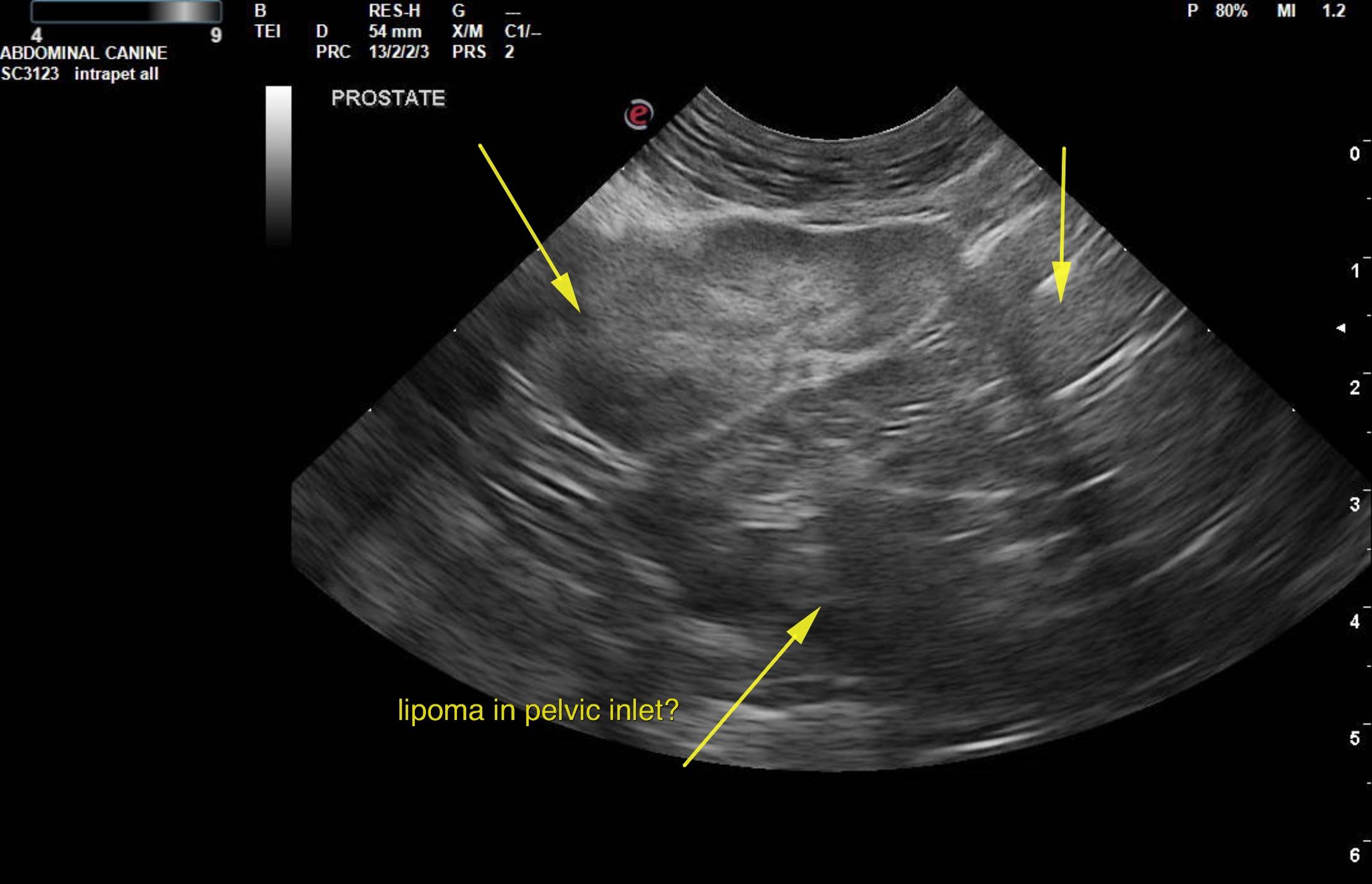 Left adrenal mass with phrenic vein and vena caval invasion in a 13 ...