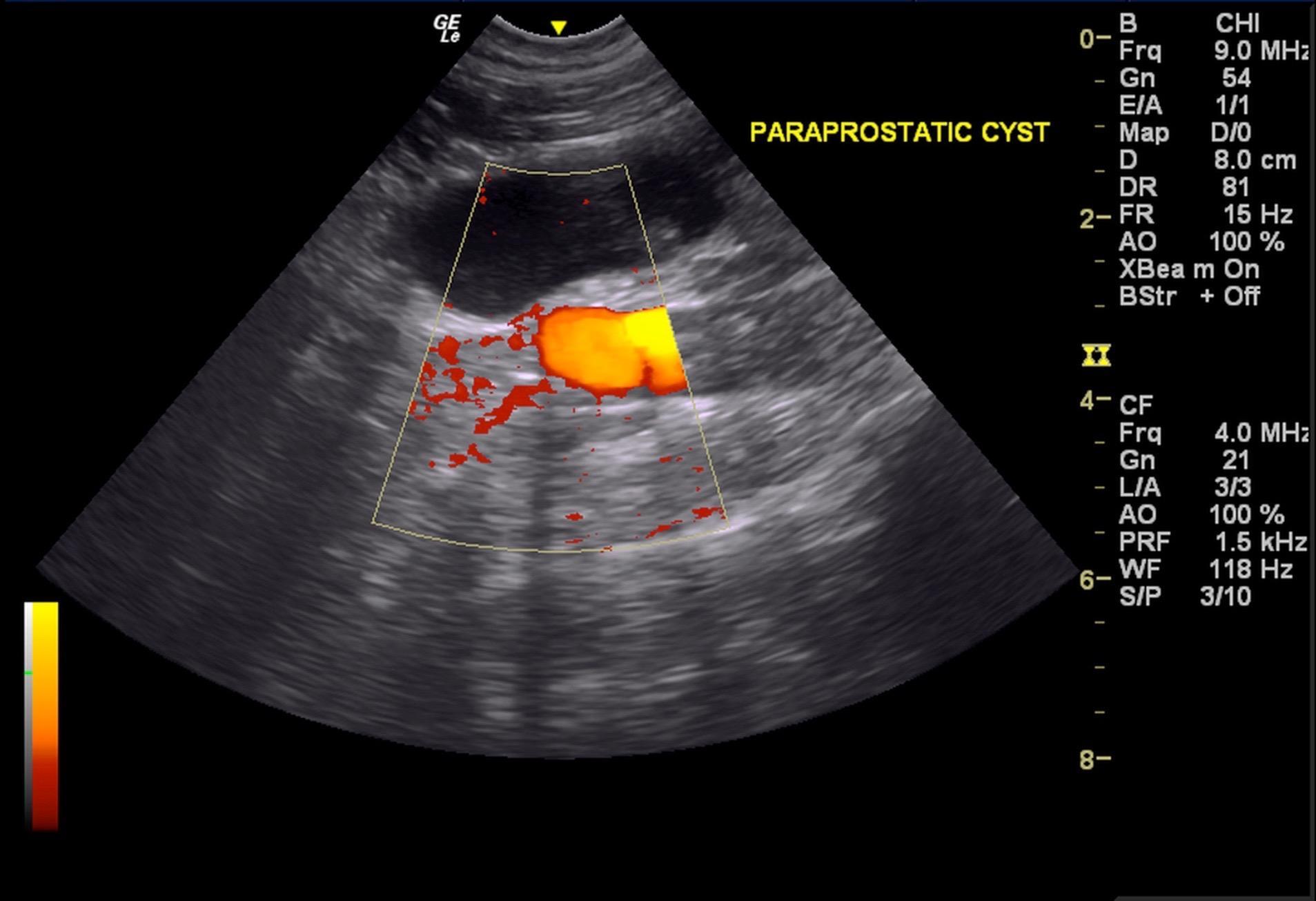 Benign prostatic hyperplasia with prostatic and paraprostatic cysts ...
