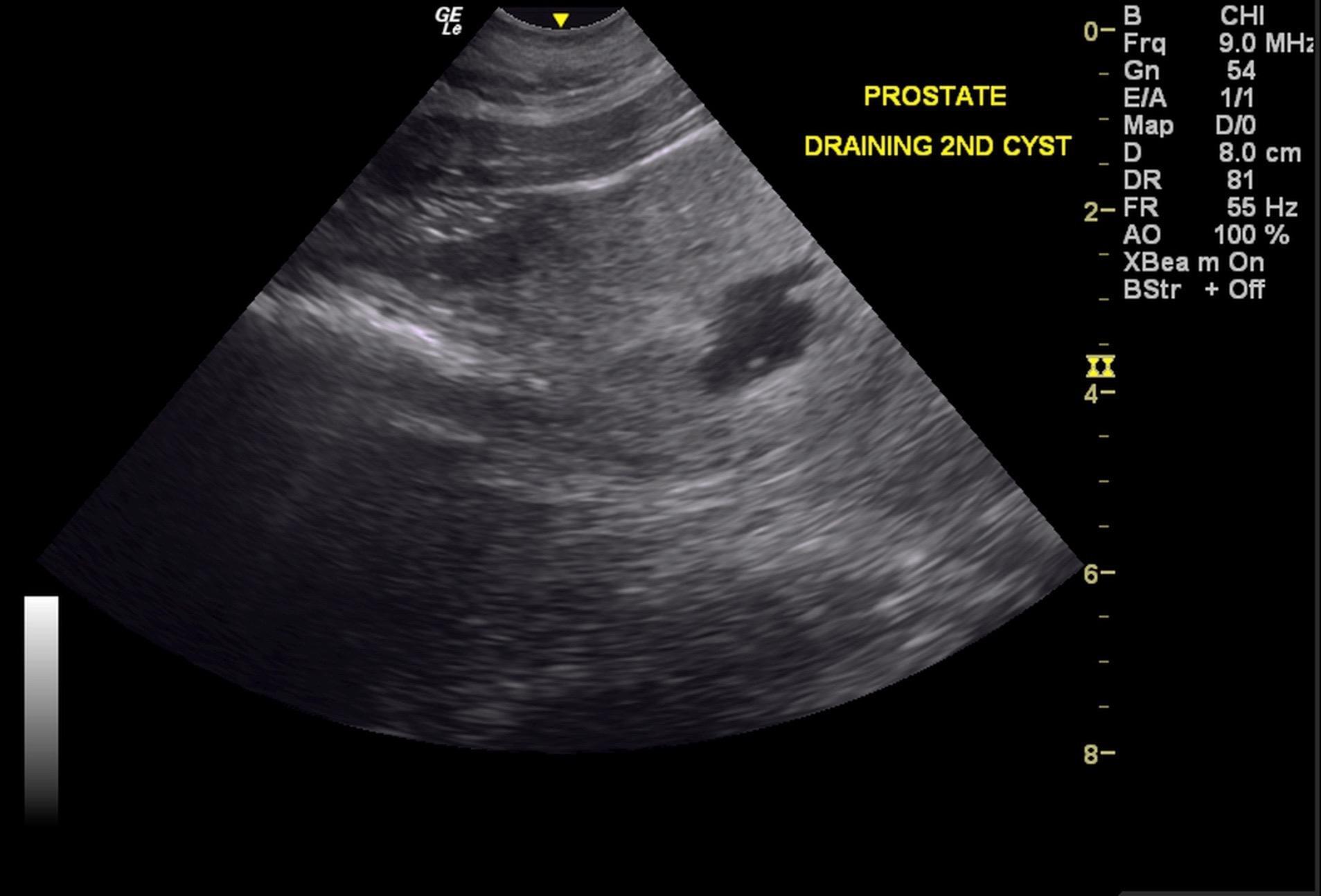 Benign prostatic hyperplasia with prostatic and paraprostatic cysts ...