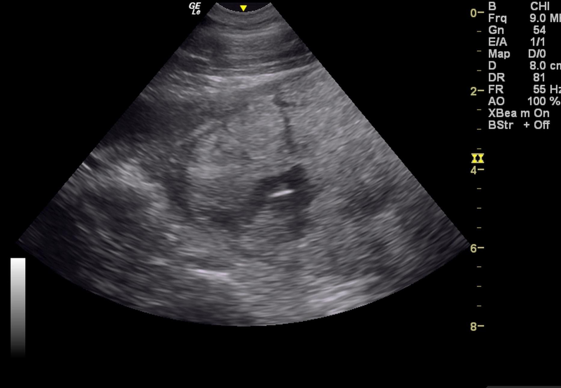 Benign prostatic hyperplasia with prostatic and paraprostatic cysts ...