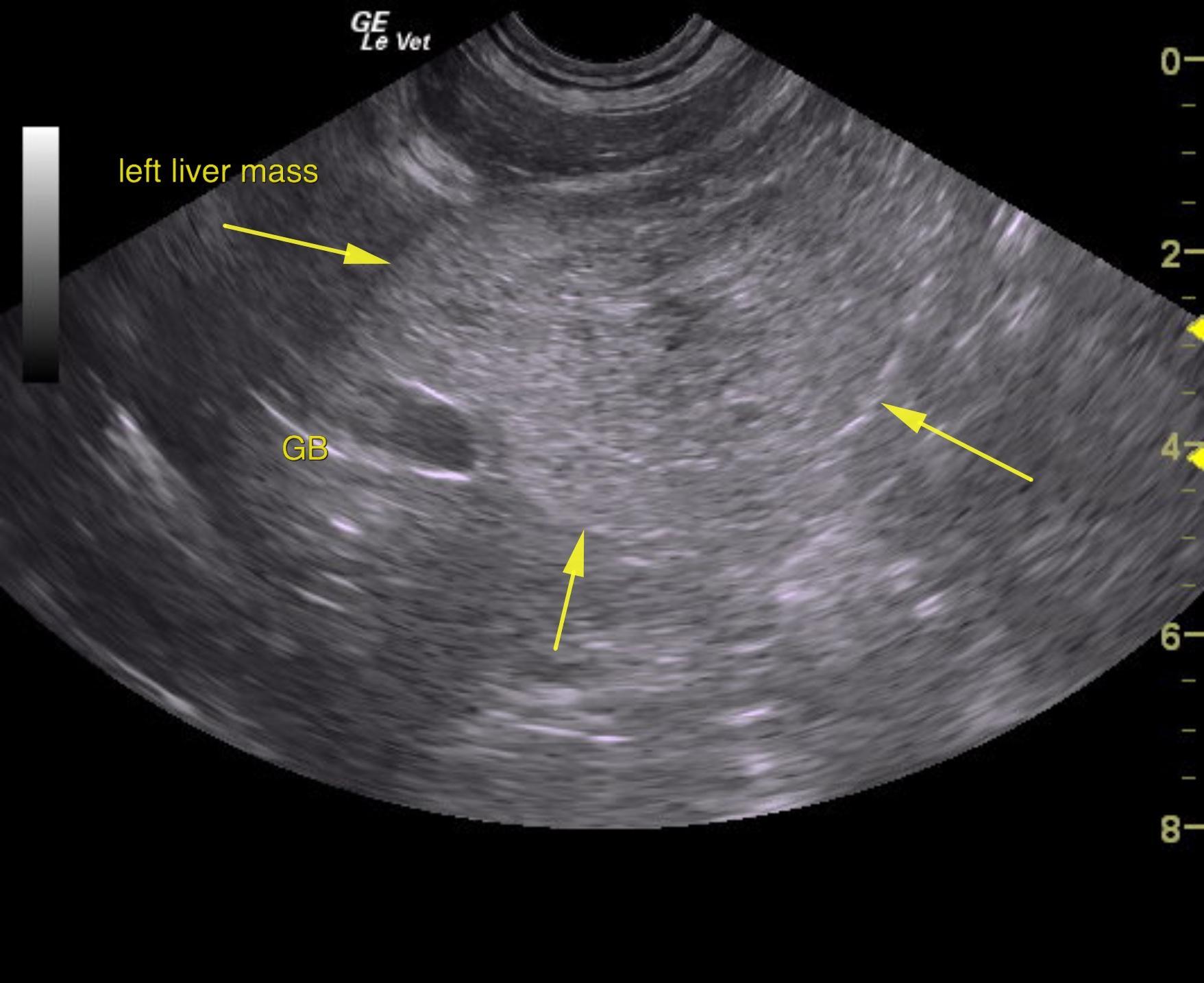 Left-sided cystadenoma liver mass impinging on the gallbladder in a 14 ...