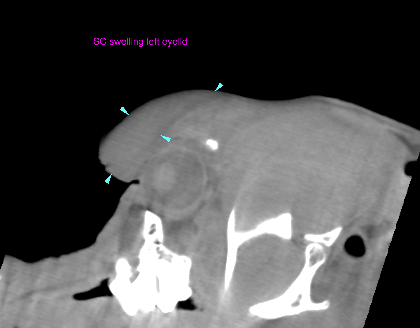 CT - Facial abscess with septic cellulitis and lymphadenitis in a 7 ...
