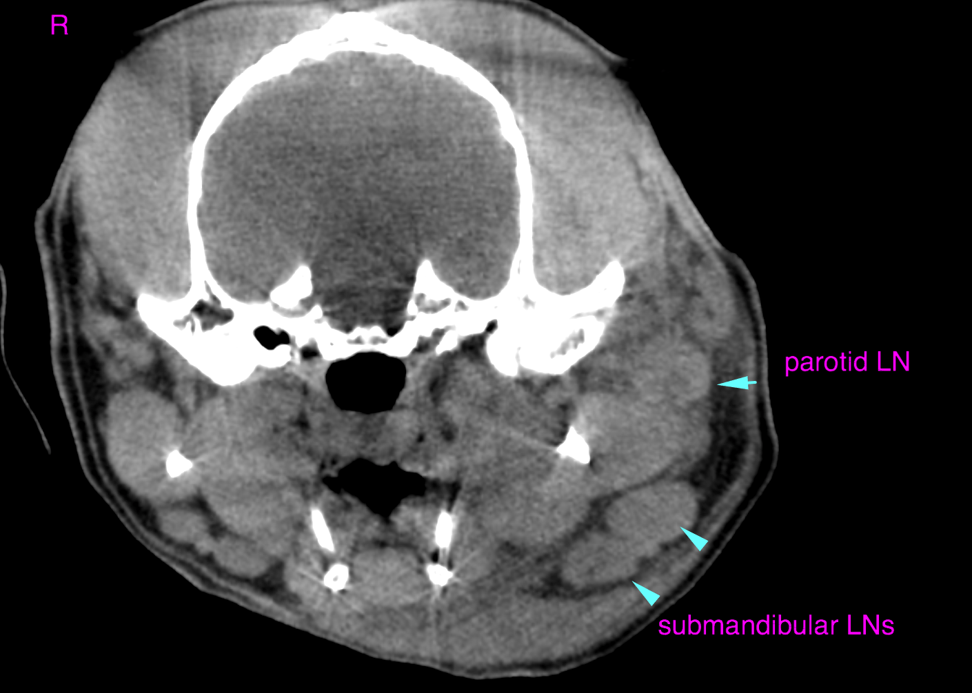 CT - Facial abscess with septic cellulitis and lymphadenitis in a 7 ...