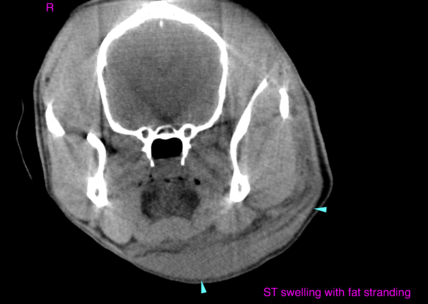 CT - Facial abscess with septic cellulitis and lymphadenitis in a 7 ...