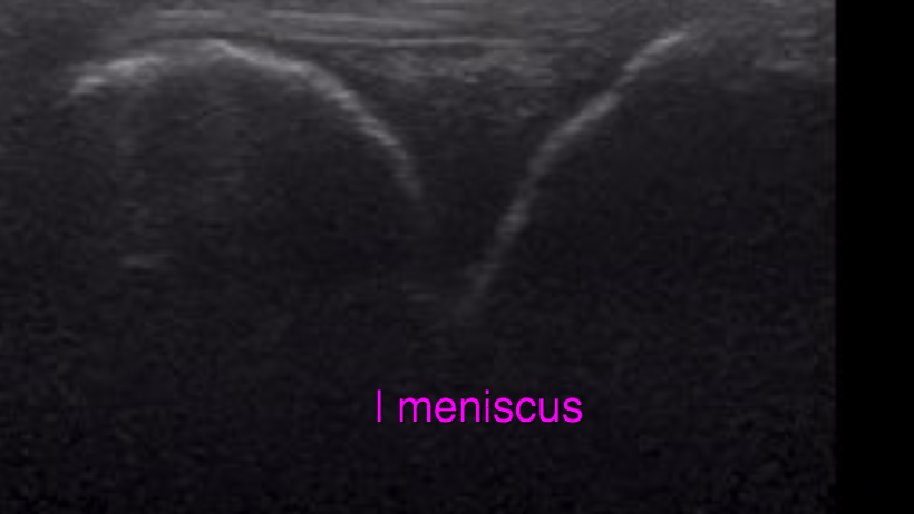 ORTHO - Partial rupture and elongation of the cranial cruciate ligament ...