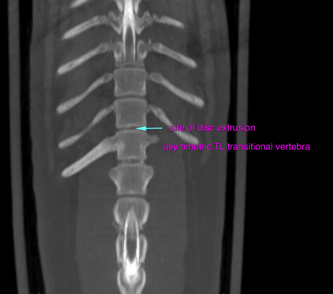 CT - Disc extrusion and severe compressive myelopathy T12-13 in a 4 ...