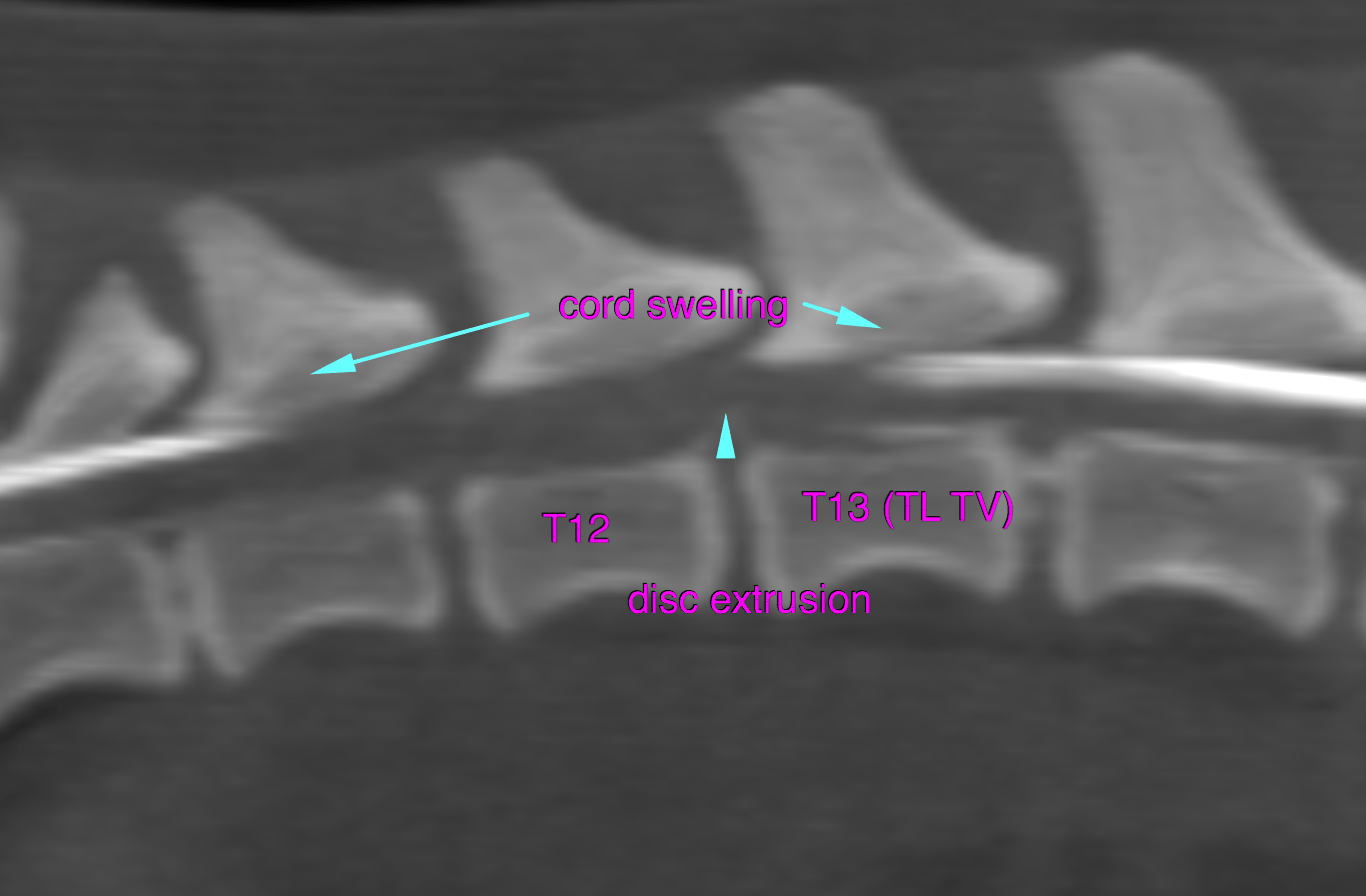 CT - Disc extrusion and severe compressive myelopathy T12-13 in a 4 ...