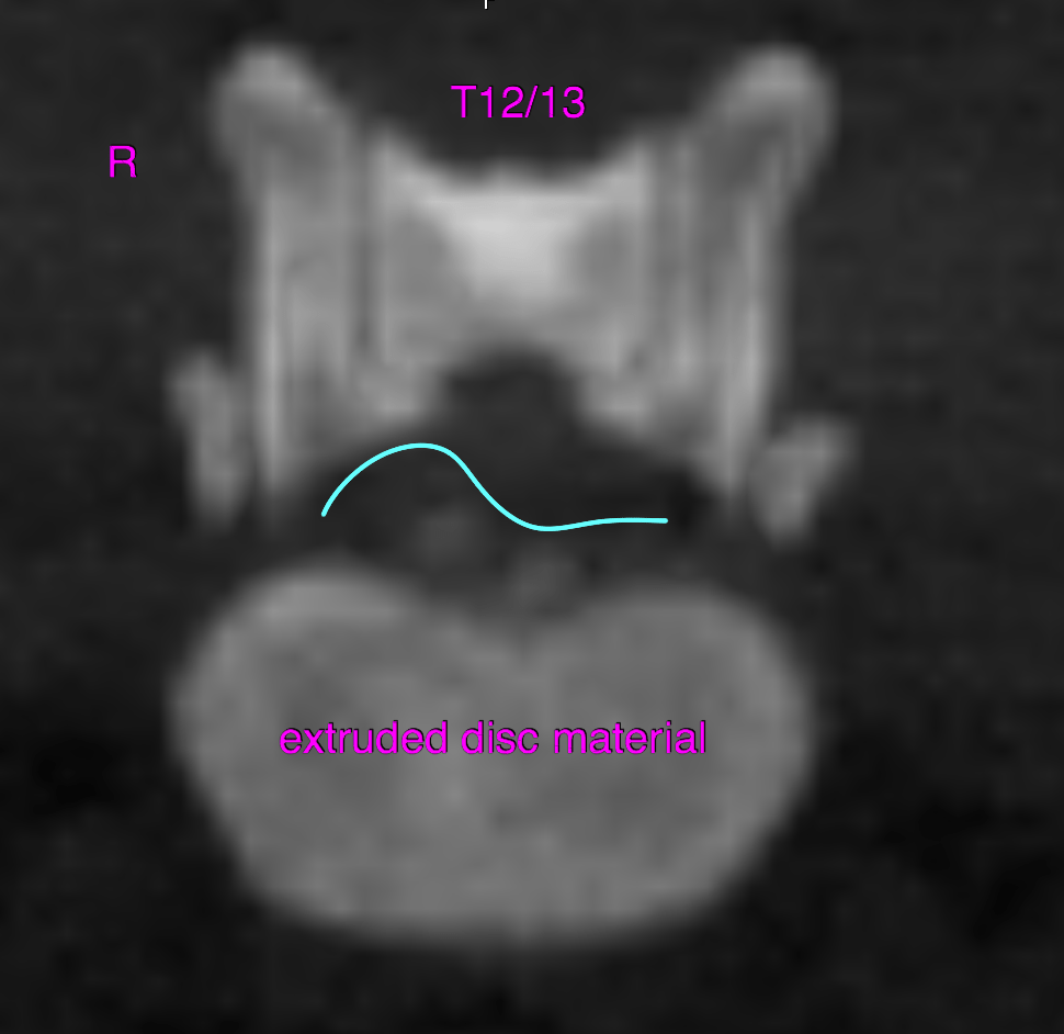 CT - Disc extrusion and severe compressive myelopathy T12-13 in a 4 ...