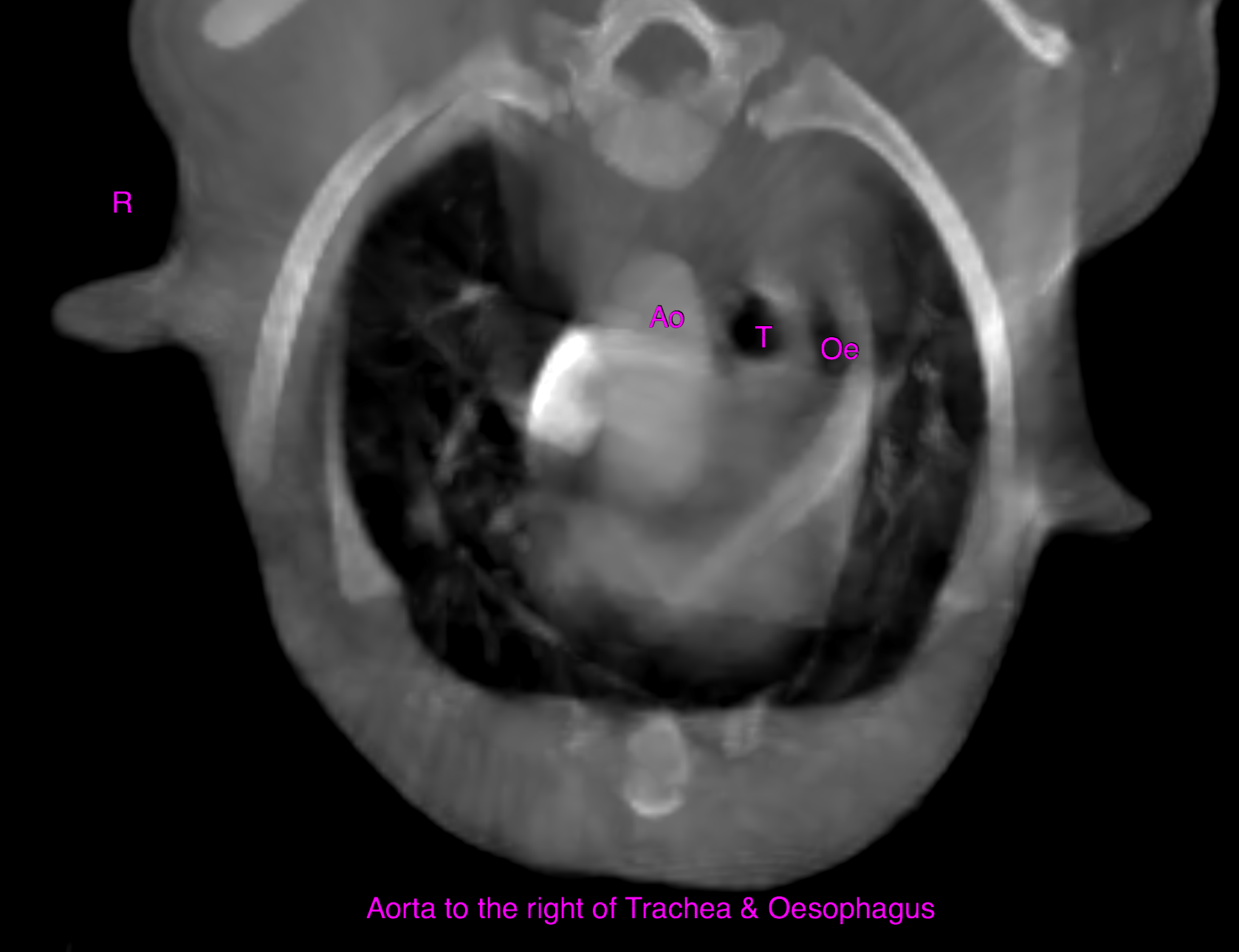 CT - Persistent right aortic arch with stenosis of the esophagus and ...