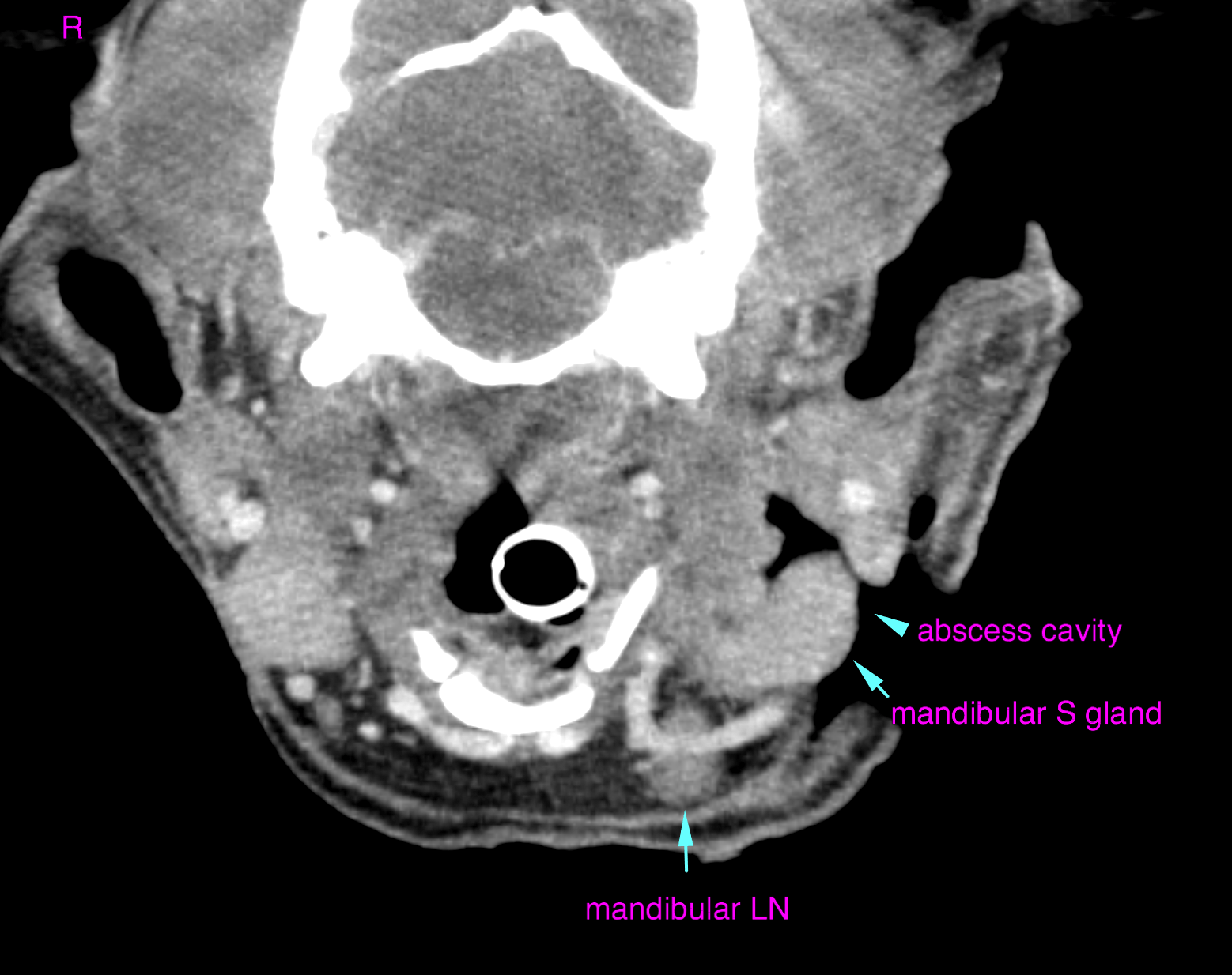 CT - Facial abscess with cellulitis and reactive lymphadenitis in a 13 ...