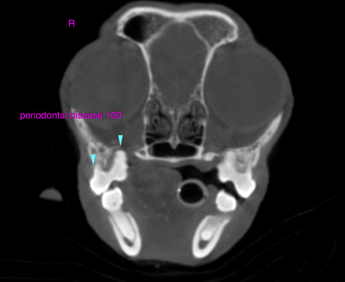 CT - Facial abscess with cellulitis and reactive lymphadenitis in a 13 ...