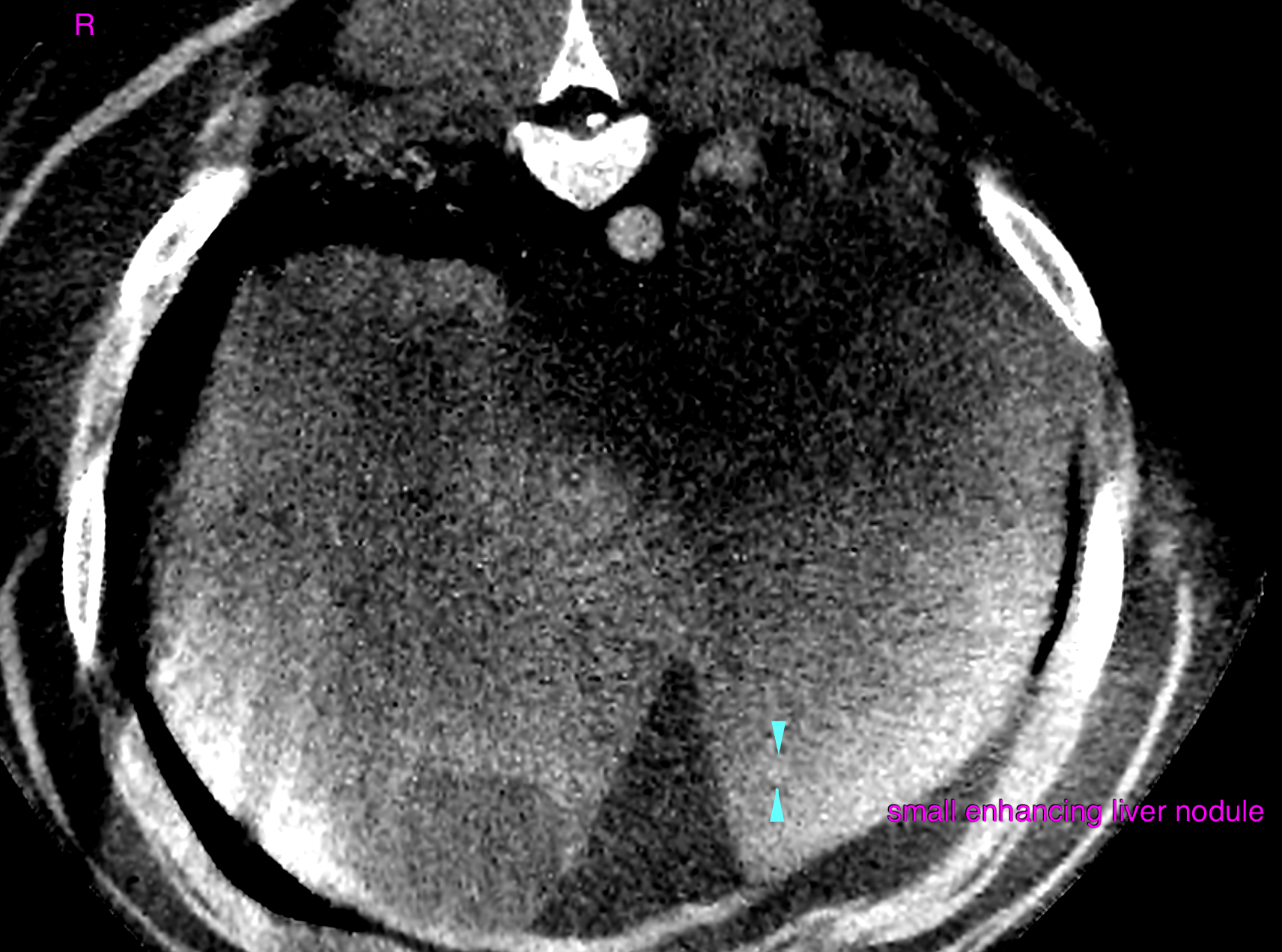 CT - multifocal soft tissue nodules of multiple organs and heart base ...