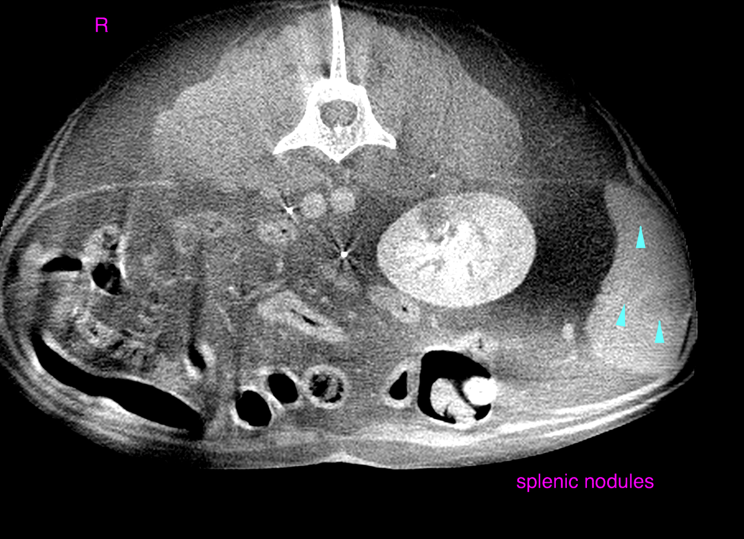 CT - multifocal soft tissue nodules of multiple organs and heart base ...