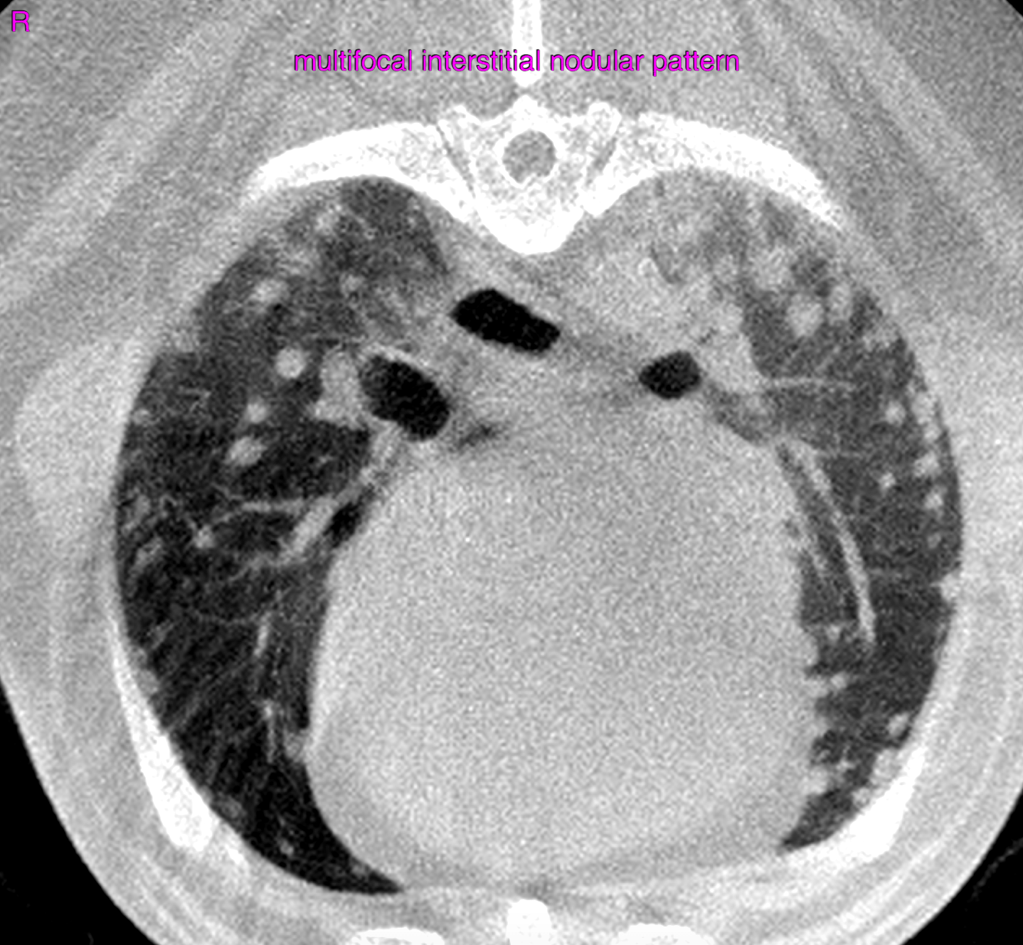 CT - multifocal soft tissue nodules of multiple organs and heart base ...