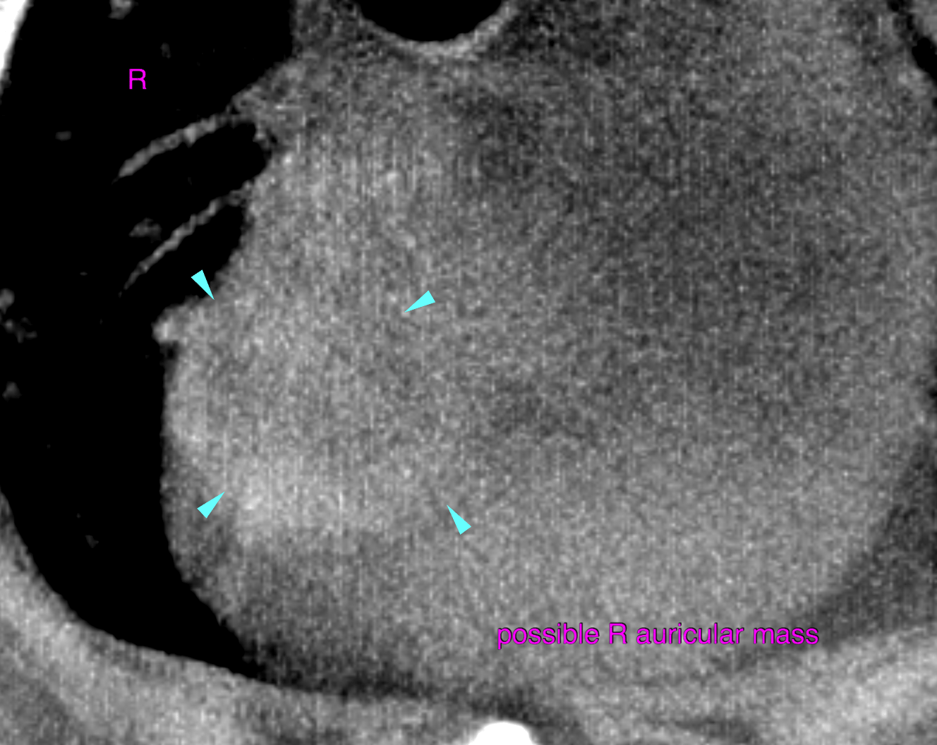 CT - multifocal soft tissue nodules of multiple organs and heart base ...