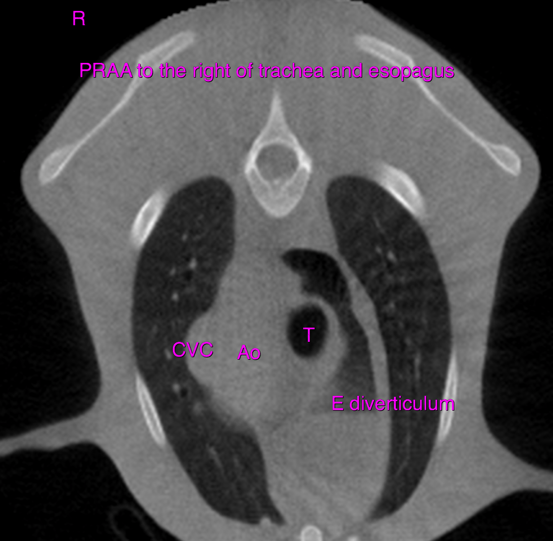 CT - Vascular ring anomaly: persistent aortic arch and megaesophagus in ...
