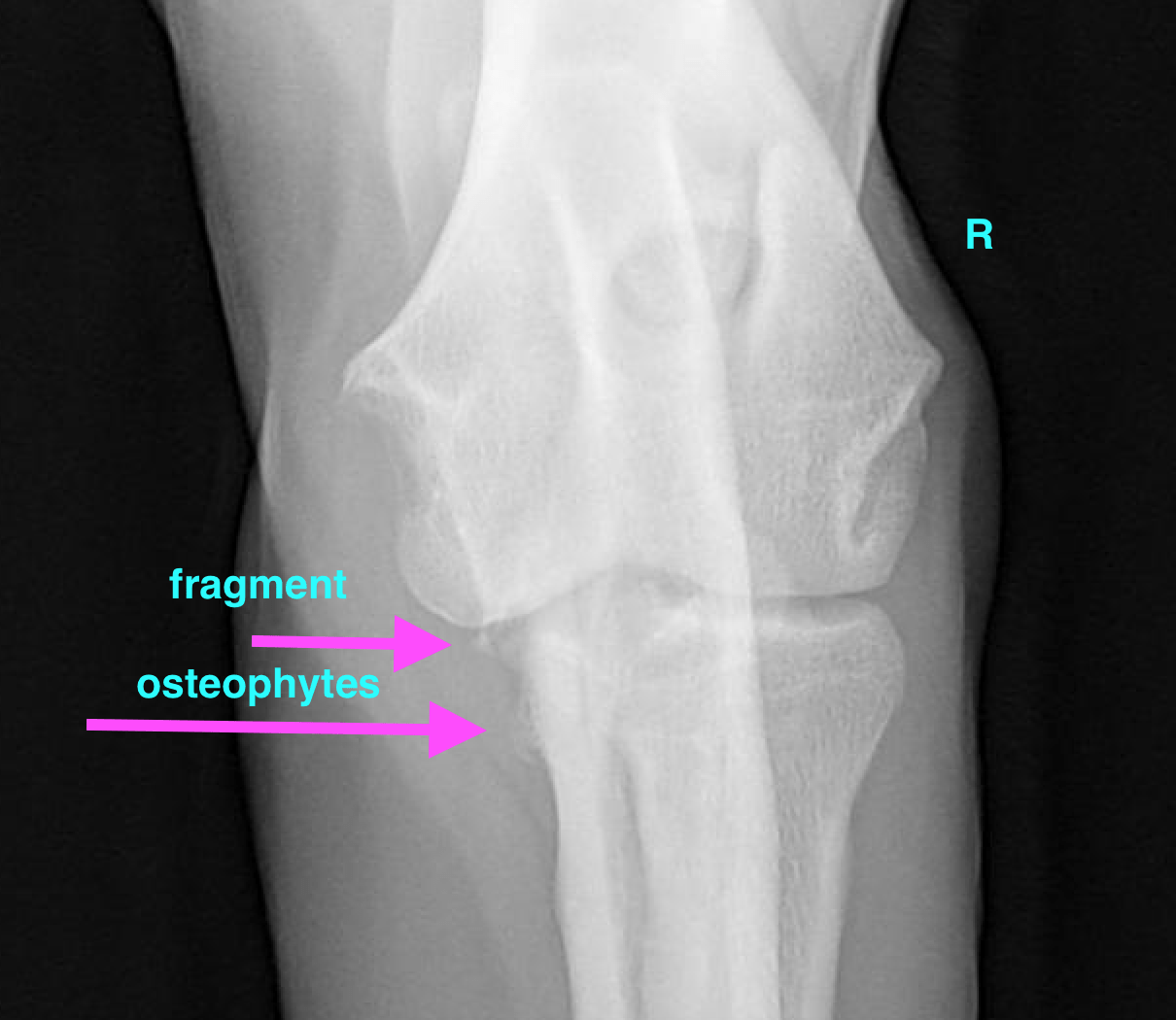 RAD - Bilateral elbow dysplasia with coronoid pathology and possible ...