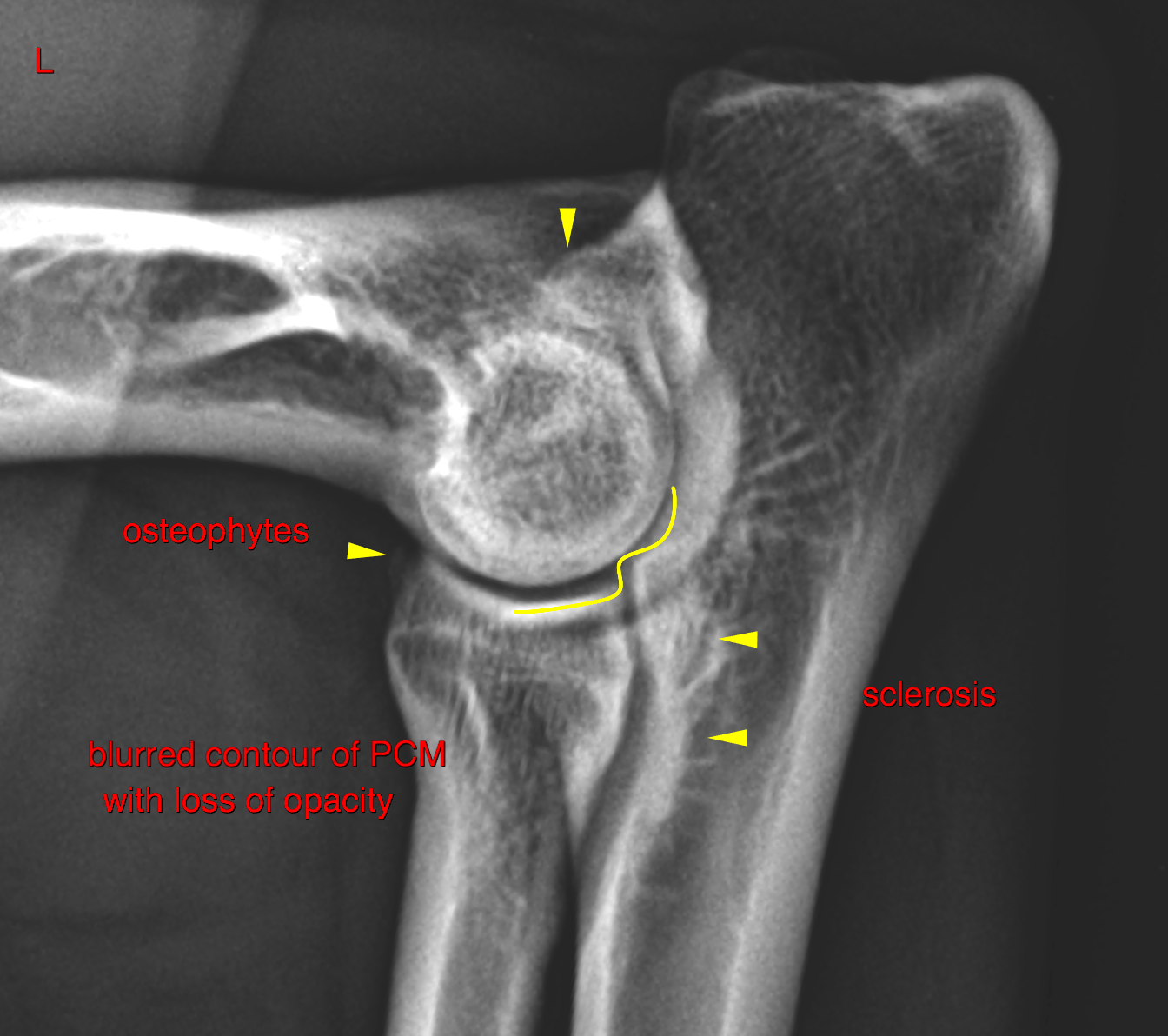 RAD - Bilateral elbow dysplasia with medial coronoid pathology in a 3 ...