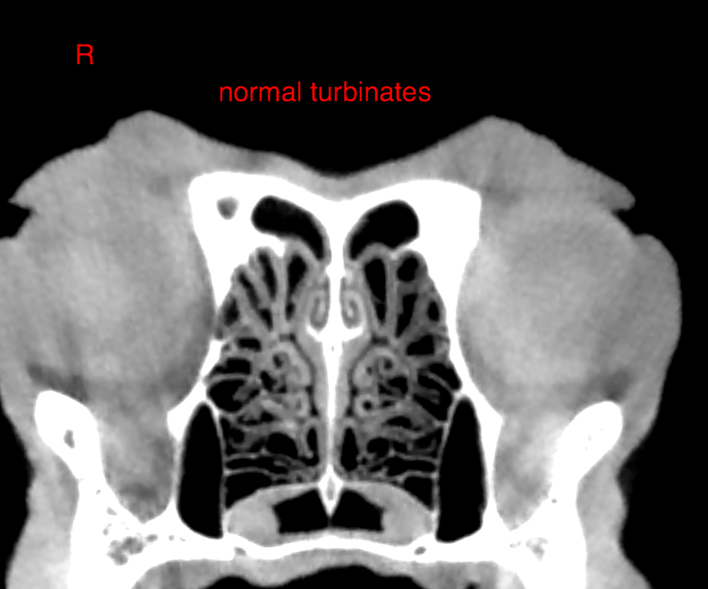 CT - Mild acute viral or parasitic rhinitis in a 6 year old FS ...