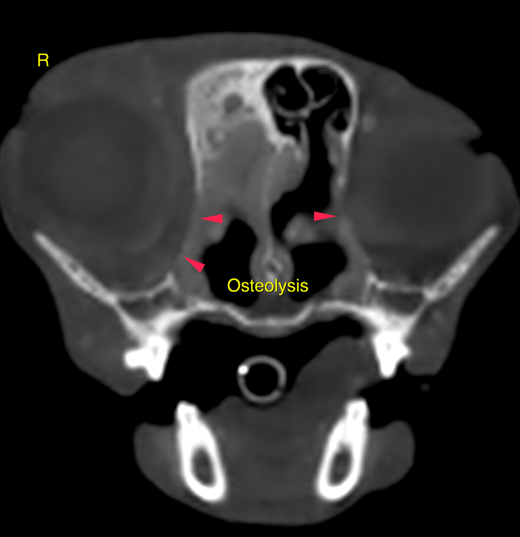 CT - Mycotic rhinitis and complete destruction of conchal and nasal ...