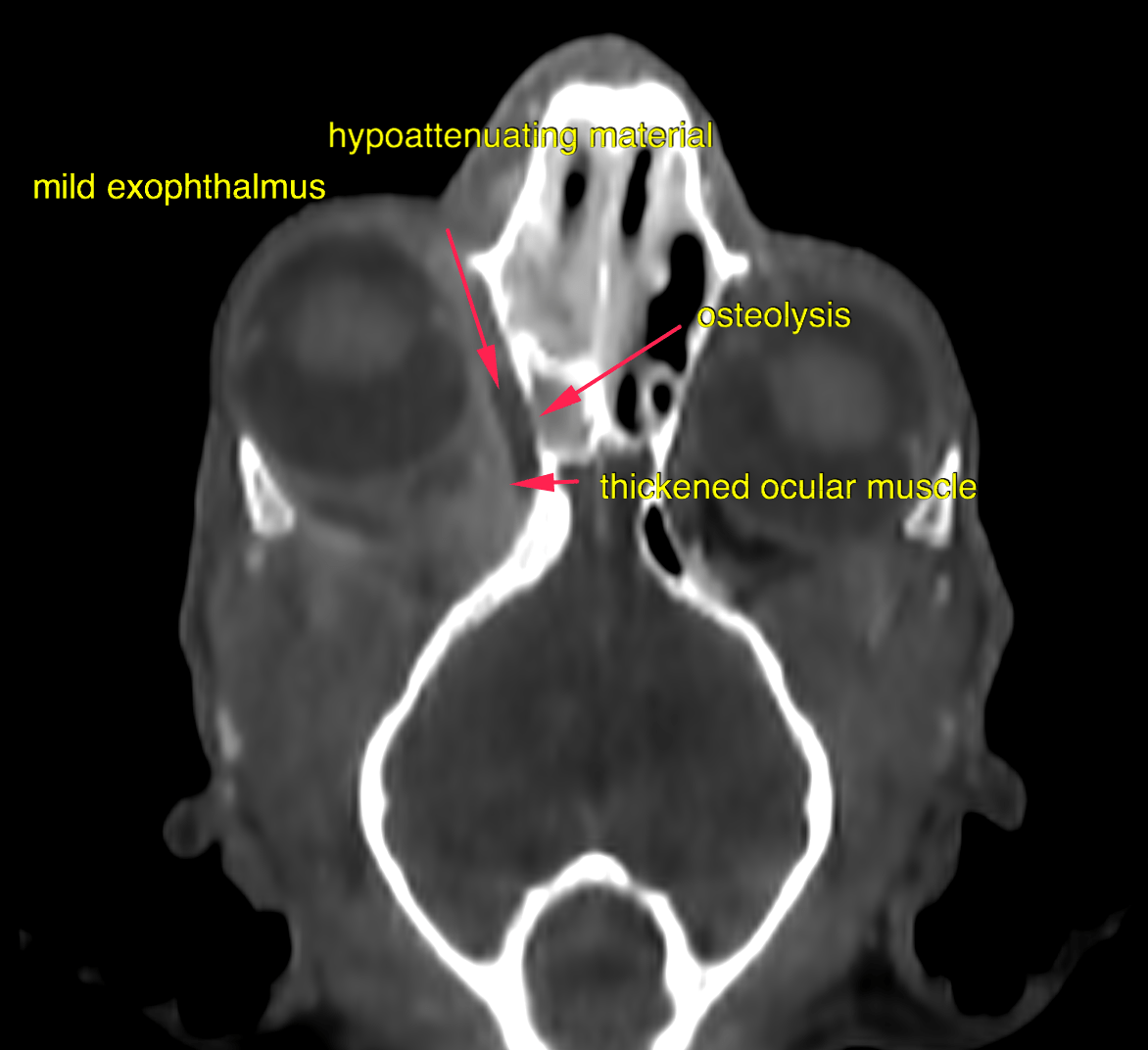 CT - Mycotic rhinitis and complete destruction of conchal and nasal ...