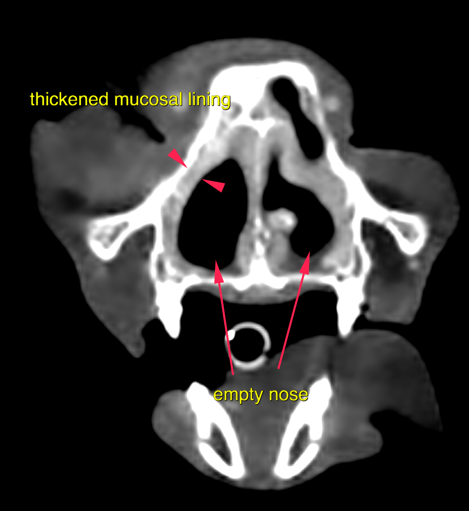 CT - Mycotic rhinitis and complete destruction of conchal and nasal ...