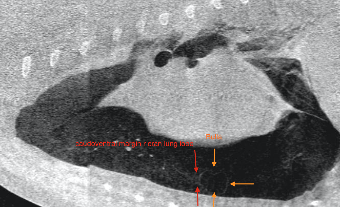 CT - Pulmonary bulla rupture with spontaneous pneumothorax in a 6 year ...