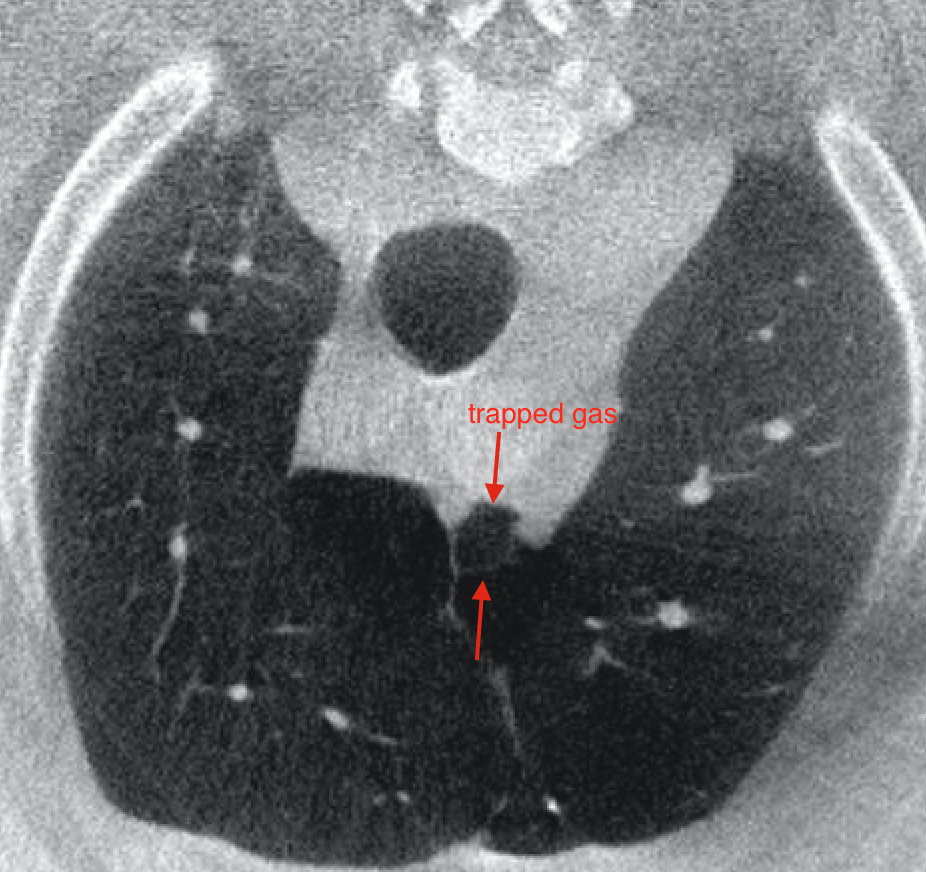 CT - Pulmonary bulla rupture with spontaneous pneumothorax in a 6 year ...