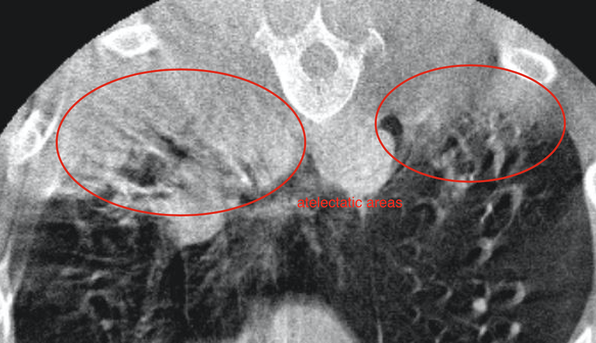 CT - Pulmonary bulla rupture with spontaneous pneumothorax in a 6 year ...