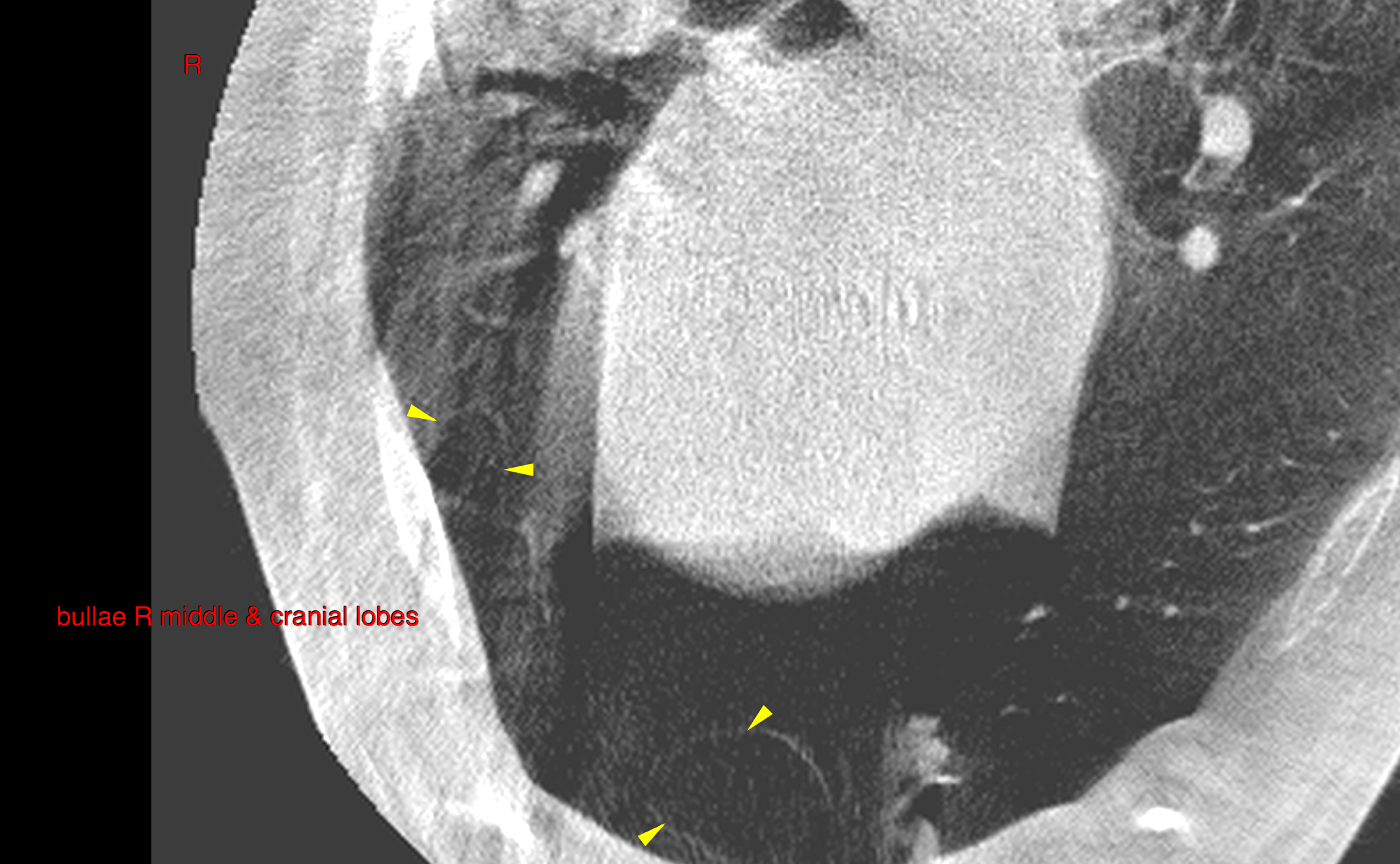 CT - Pulmonary bulla rupture with spontaneous pneumothorax in a 6 year ...