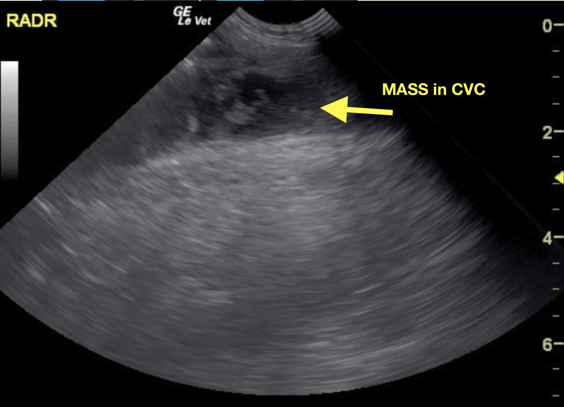 Right Adrenal Mass With Vascular Invasion and Caudal Vena Cava Syndrome ...