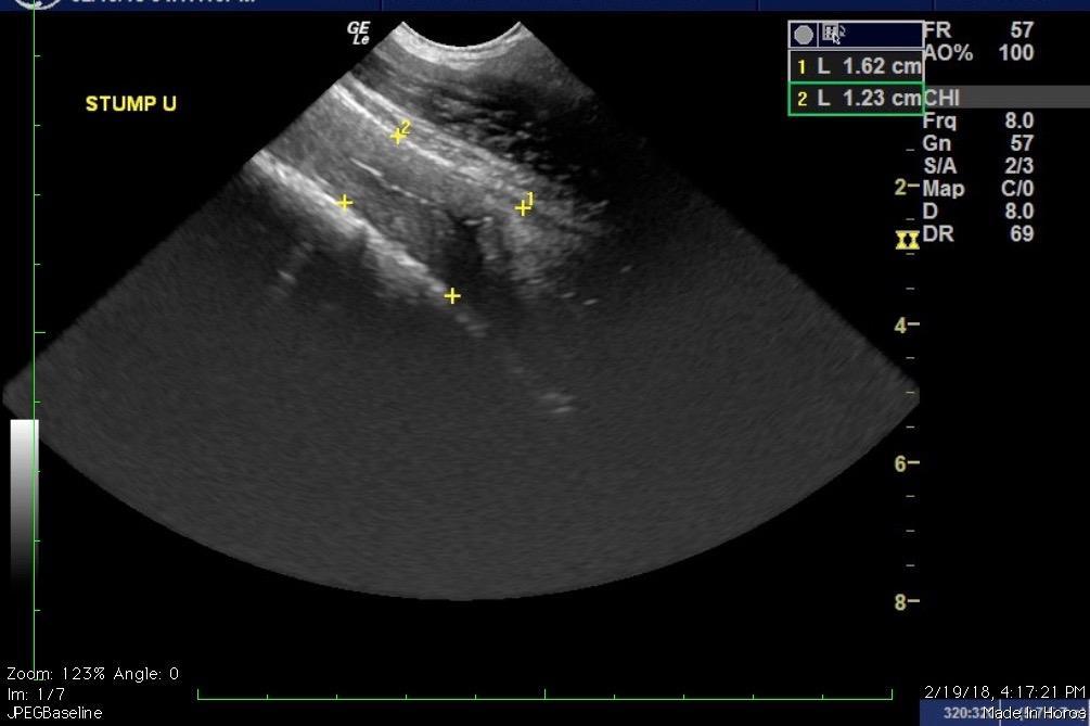 Left horn pyometra with cystic left ovary in a 2 year old presumed ...