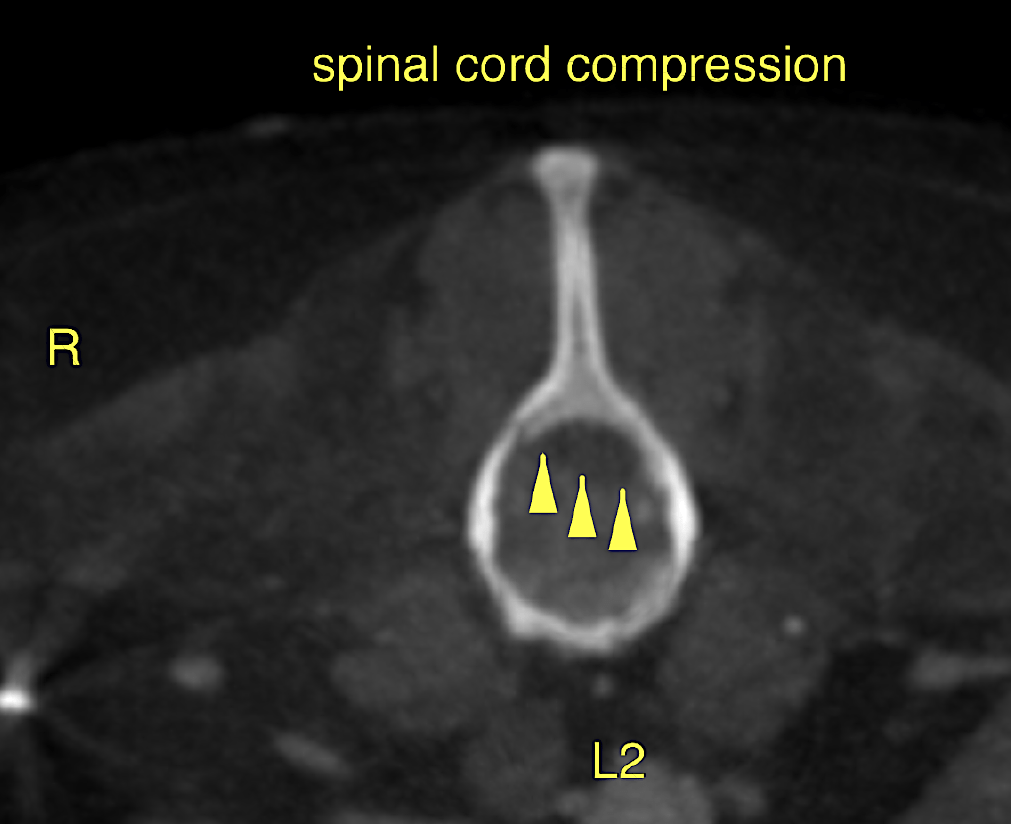 Monostotic Aggressive Osteolytic Lesion in an 11-Year-Old MN Yorkshire ...