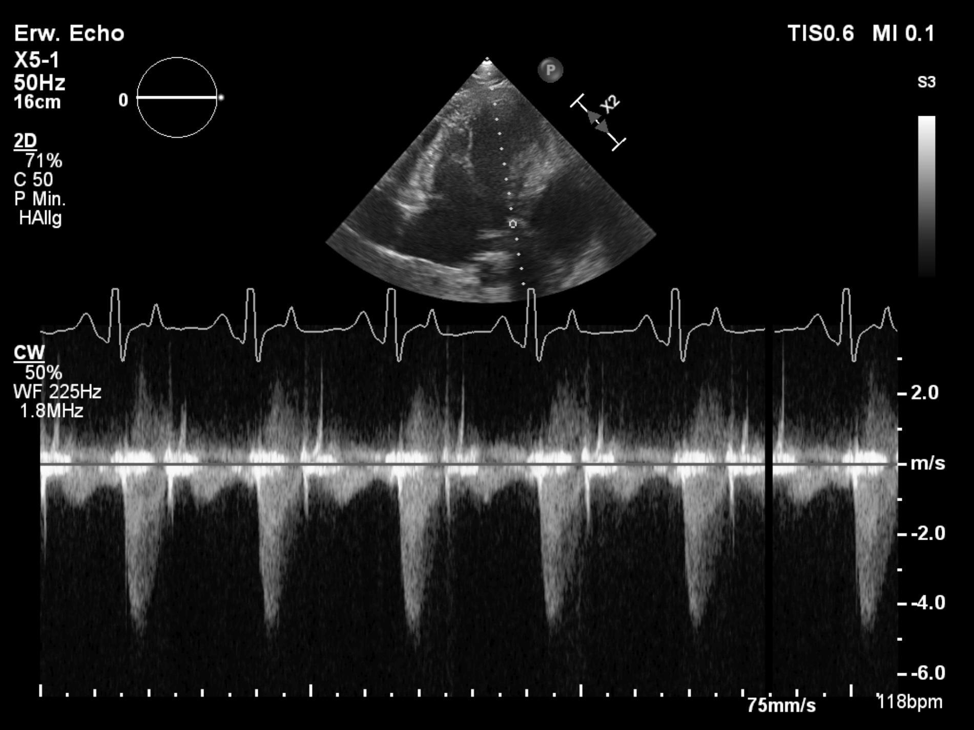 PDA, Valvular Aortic Stenosis, Valvular Pulmonic Stenosis and Mitral ...