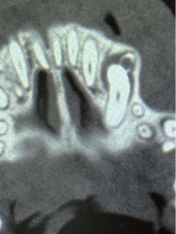 Persistent Deciduous Teeth, Unerupted Permanent Teeth, Dentigerous Cyst ...