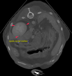 CT - Cystolithiasis with multiple cortical renal cysts in a 10 year old ...