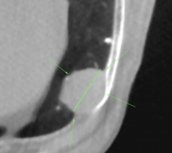 CT - Pleural Soft Tissue Neoplasia, possible Malignoma, in a 14 year ...